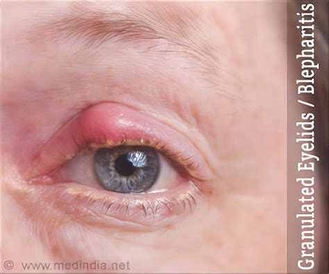 Angular Blepharoconjunctivitis