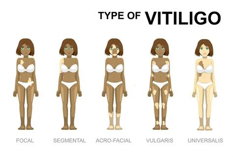 Vitiligo Treatment In Dubai Restore Skin Pigmentation
