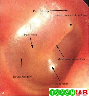 Pediatric Atlas Of Otitis Media Acute Otitis And Otitis Media With