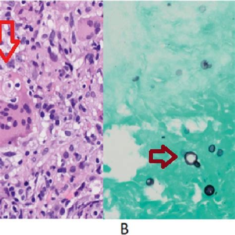 2a Lung Tissue Showing Non Necrotizing Granulomatous Inflammation Download Scientific Diagram