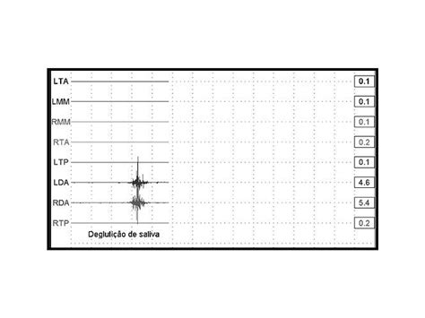 Semg Tracing Normal Swallow Courtesy Of Myotronics Tukwila