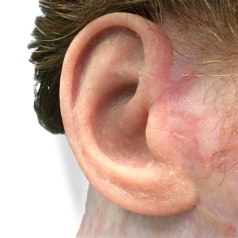 Ear Prosthesis Pes Planus