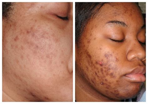 Hyperpigmentation Face Before And After