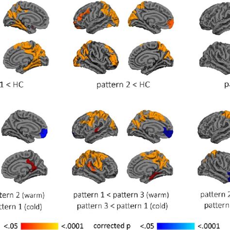 Cortical Atrophy Patterns At 3 Cluster Level A Color Maps Indicate