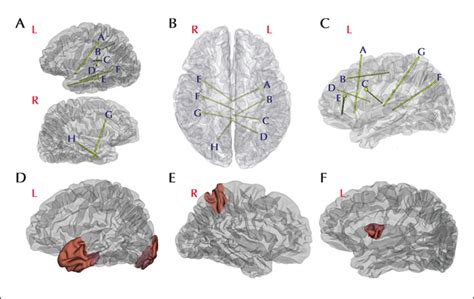 JLE Epileptic Disorders Limb Loss Experience Evoked By Electric Cortical Stimulation