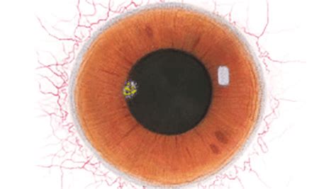 Efron Grading Scales Coopervision Canada