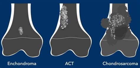 Parkinson Mnemonic