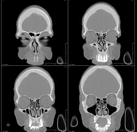 Revision Sinus Surgery Sinus Surgery Center Uci Ent Sinus Surgery
