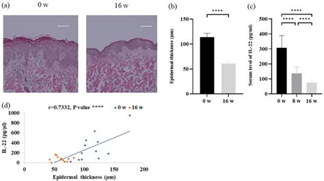 Analysis Of Epidermal Thickness And Il 22 In Atopic Dermatitis Patients