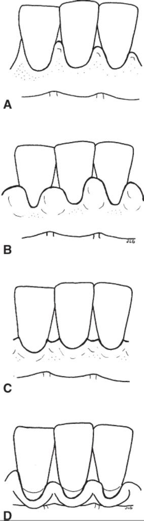 Test 3 Gingival Shape Contour Image Diagram Quizlet