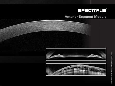 Pdf Anterior Segment Module · Sclera And Anterior Chamber Angles