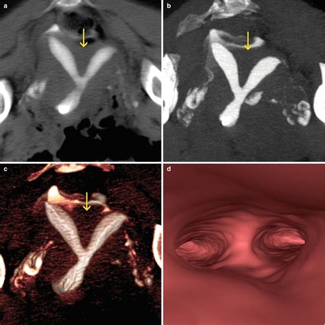 Morphological Post Treatment Changes Radiology Key