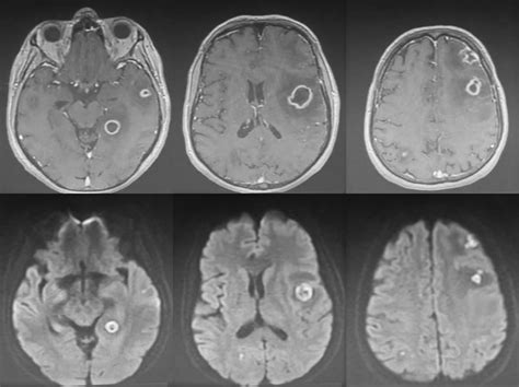 Brain Magnetic Resonance Imaging MRI Scan Showing Multiple