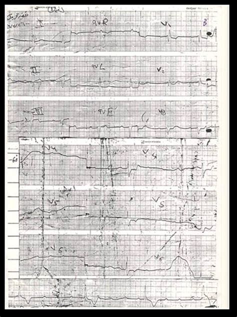 B Technically Very Poor Quality Ecg Of The Same Patient In A Showing Download Scientific