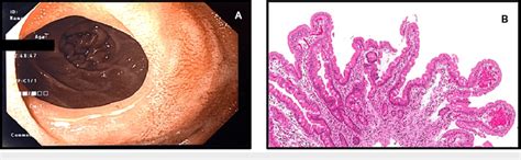 Endoscopic Mucosal Resection Of The Duodenal Duplication