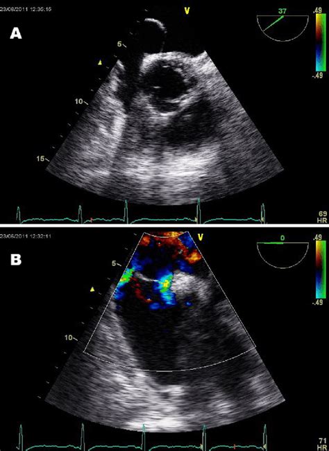 Transoesophageal Echocardiography A Interatrial Septal Aneurysm B Download Scientific
