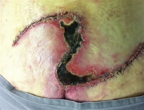Partial Necrosis Of The Fasciocutaneous Bilaterally Located Flap