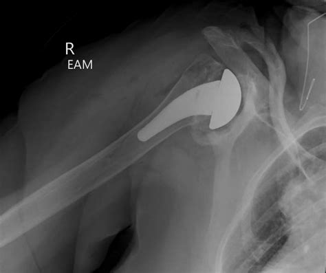 Shoulder And Elbow Surgery Failed Glenoid Component After Anatomic Shoulder Arthroplasty With
