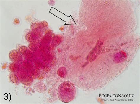 Examen General De Orina