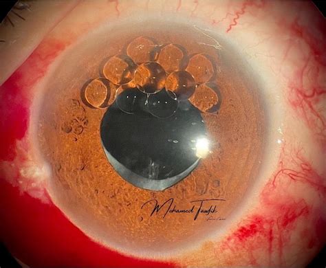 Mohamed Tawfik On Linkedin 1st Day Post Vitrectomy 🙂🙂🙂