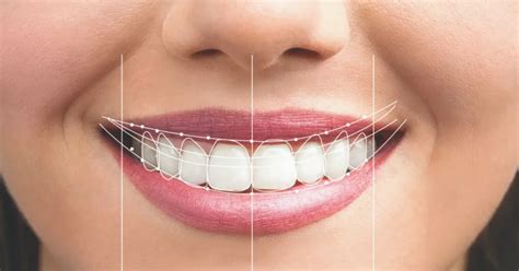 El Proceso De Transformación De La Sonrisa Hollywood Qué Esperar
