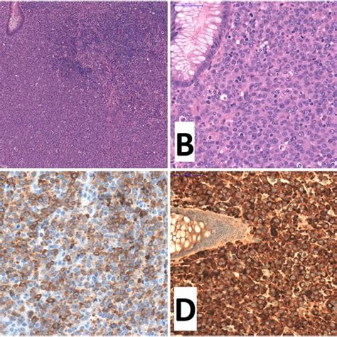Histology Of The Removed Appendix A Diffuse Infiltrate Of Blasts Was Download Scientific