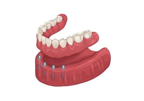 What Are Implant Dentures Authority Dental
