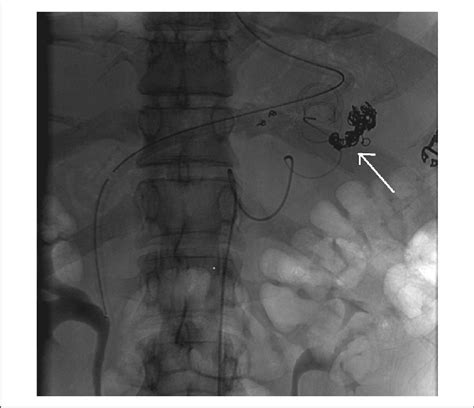 Coil Embolization Pseudoaneurysm At Madalyn Hartley Blog