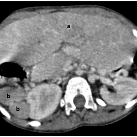 11 Month Old Male Infant With Polysplenia Syndrome Findings Abdominal