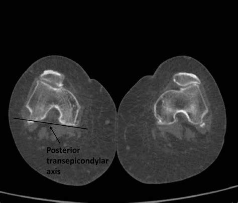 Figure 1 From Ct Assessment Of Femoral Neck And Acetabular Anteversion In Patients With Severe