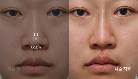 올리팅리프팅클리닉 강남역 위치 피부과병원