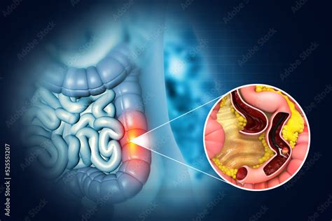 Colonoscopy Inside Colon Colonoscopy Colon Illustrations Diagnosis