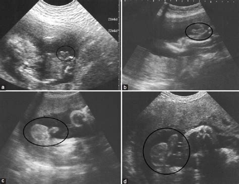 The Accuracy Of 2D Ultrasound Prenatal Sex Determination PMC