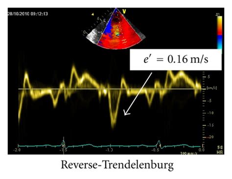 Examples Of Echocardiographic Indices Of Diastolic Function In The Download Scientific Diagram