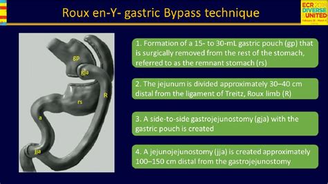 Figure 4 From Roux En Y Gastric Bypass Postsurgical Anatomy And Common Complications A Primer
