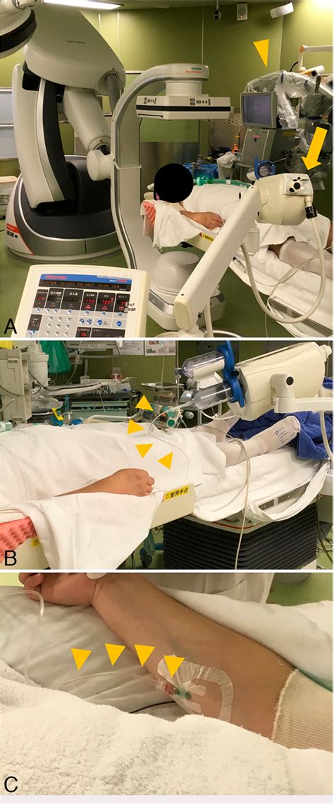 Figure 1 From Visualization Of Extracranial Intracranial Bypass In Moyamoya Patients Using