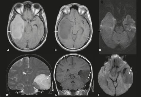 Medial Temporal Lobe Mri
