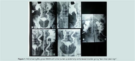 Figure 1 From Pelvic And Abdominal Lipomatosis A Rare Case Report With Atypical Presentations