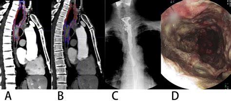 Comparative Analysis Of Automatic Segmentation Of Esophageal Cancer Using 3d Res Unet On