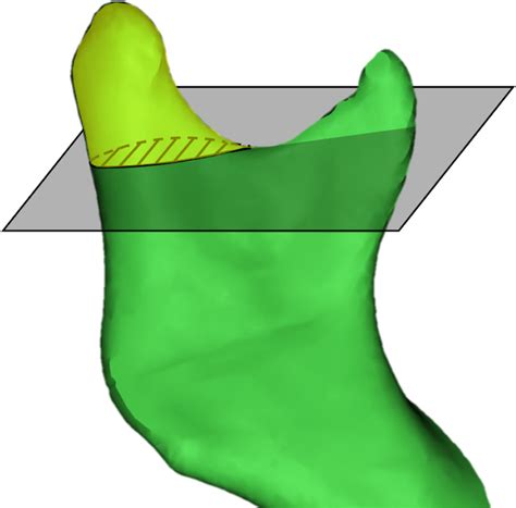 Measurement Of The Surface Area And Volume Of The Condyle The Part Of