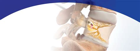 Intracept® Doctors In Phoenix Area Az Orthoarizona