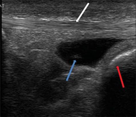 Ultrasonographic Findings In A Large Series Of Patients With Knee Pain