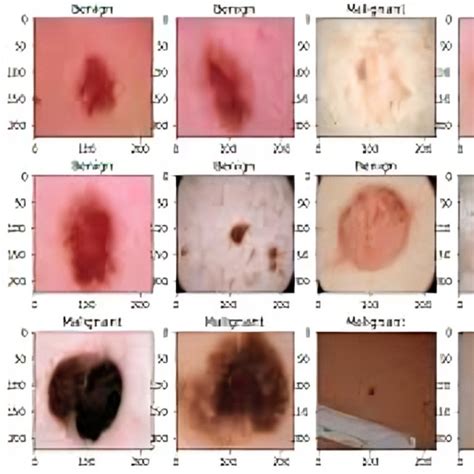 Skin Cancer Detection Kaggle