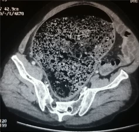 Ct Scan On Admission Showing A Very Dilated Sigmoid Colon Filled With Download Scientific
