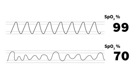Normal Oxygen Saturation Waveform With Poor Baseline Waveform Monitoring 17075569 Vector Art At