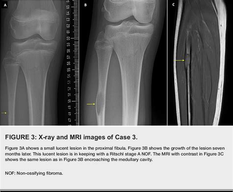 Figure 3 From Imaging Of Non Ossifying Fibromas A Case Series Semantic Scholar