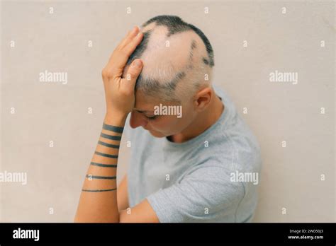 Real Alopecia Areata In A Young Girl A Bald Head In A Person Diffuse