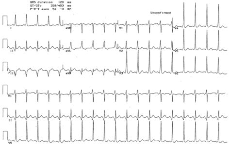 Pediatric Svt Ecg