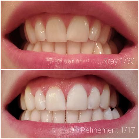 Just Started Refinements And Had Some Ipr Done No Attachments For A Couple Of Weeks So I Can