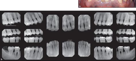 Figure 2 From Posterior Bite Collapse Guidelines For Treatment Based On Form And Function